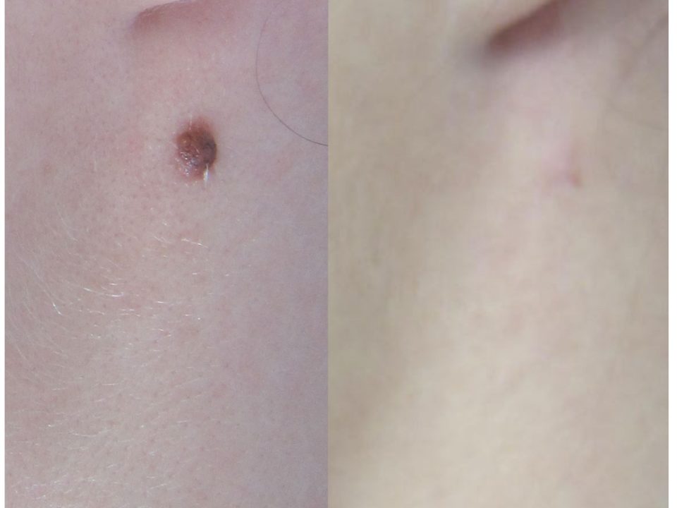 Acne, Facial Hair, and Skin Tag treatments at Nell clinic